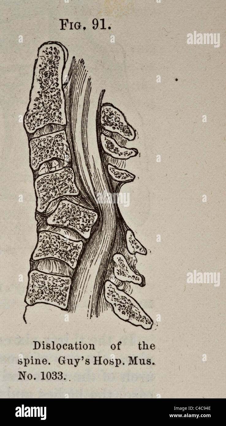Antique Medical Illustration of the Spine circa 1881 Stock Photo - Alamy