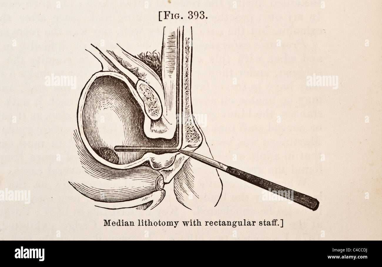 Lithotomy bladder hi-res stock photography and images - Alamy