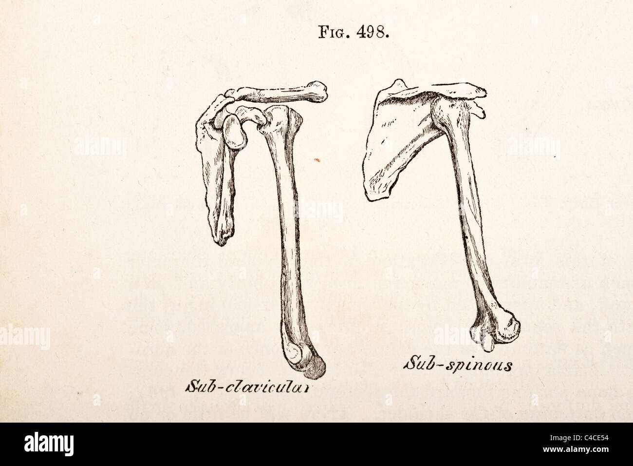 Antique Medical Illustration Depicting Dislocation of the Humerus Stock ...