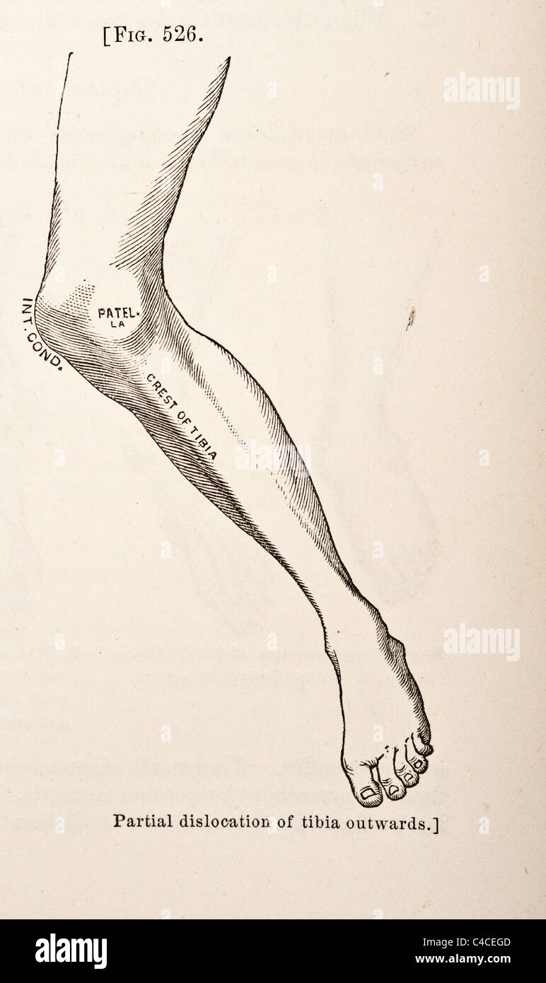 Anterior knee dislocation tibia femur hi-res stock photography and ...