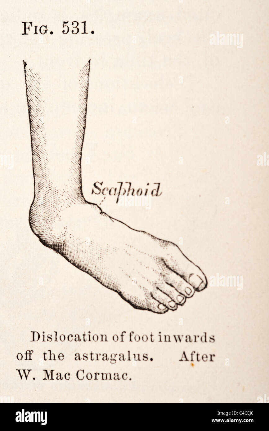 Antique Medical Illustration Showing Dislocation of the Foot Stock ...