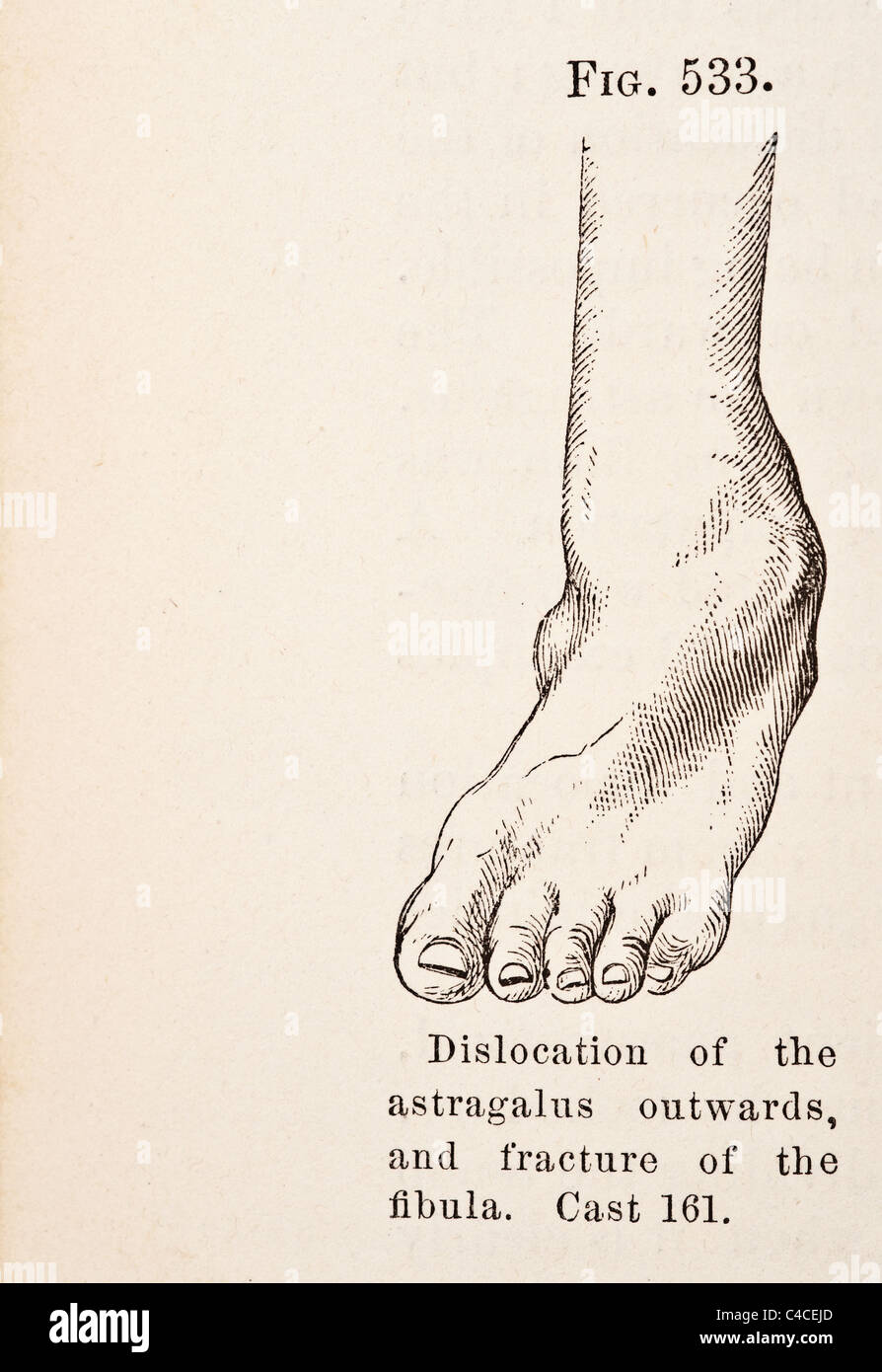 Antique Medical Illustration Showing Dislocation of the Foot Stock ...
