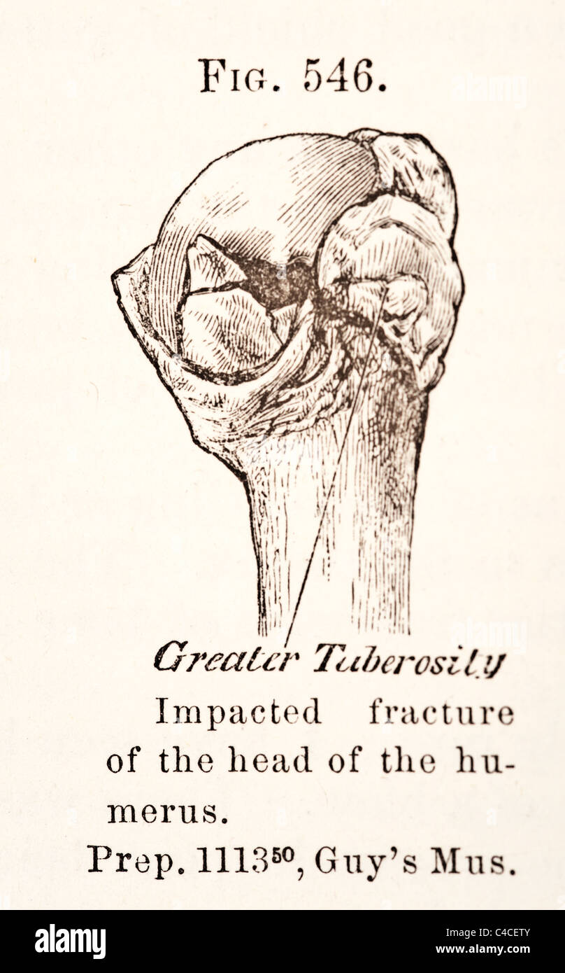 Antique medical illustration of a hip bone, ball & socket Stock Photo ...