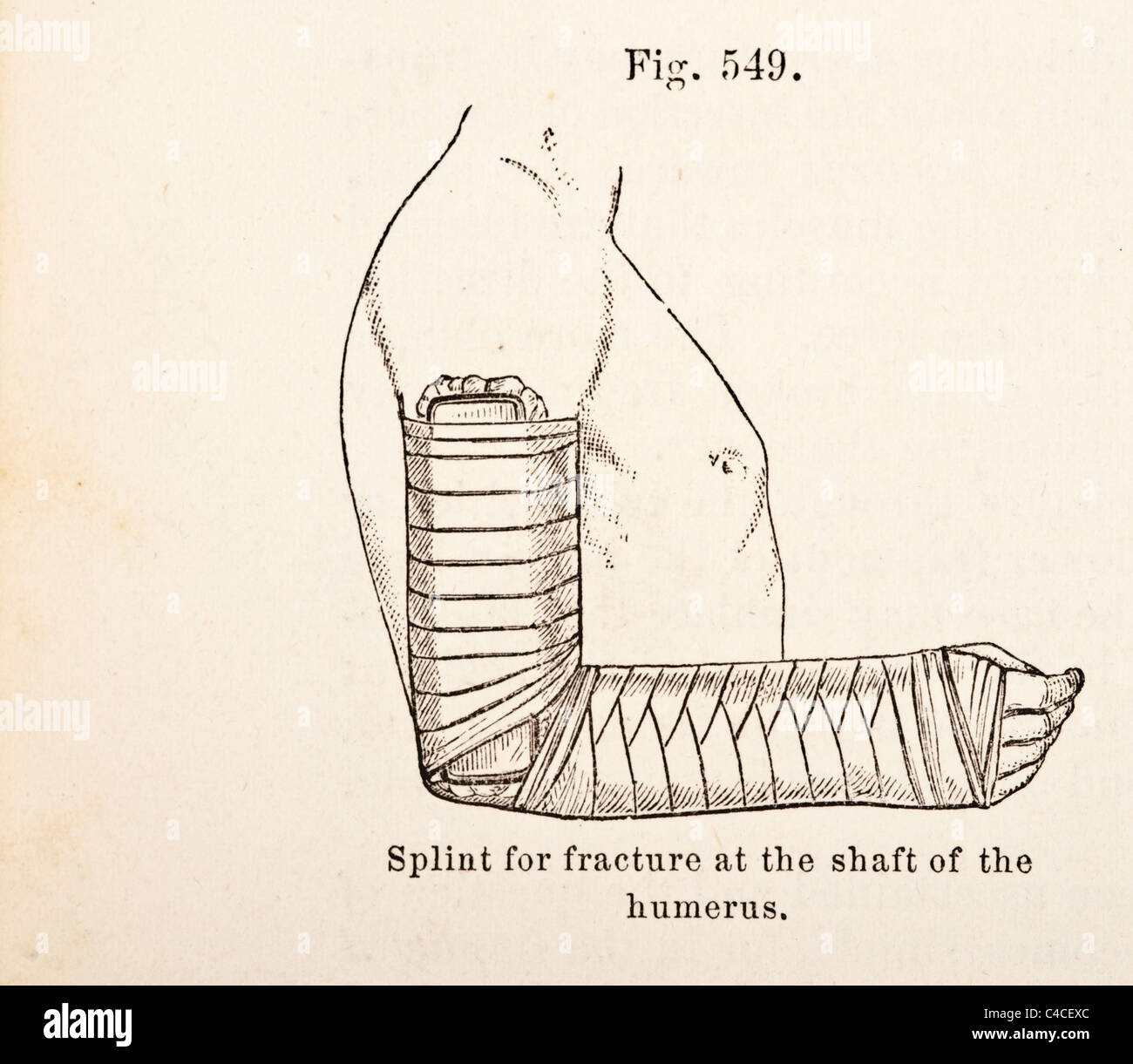 A splint for a fracture of the humerus circa 1881 Stock Photo - Alamy