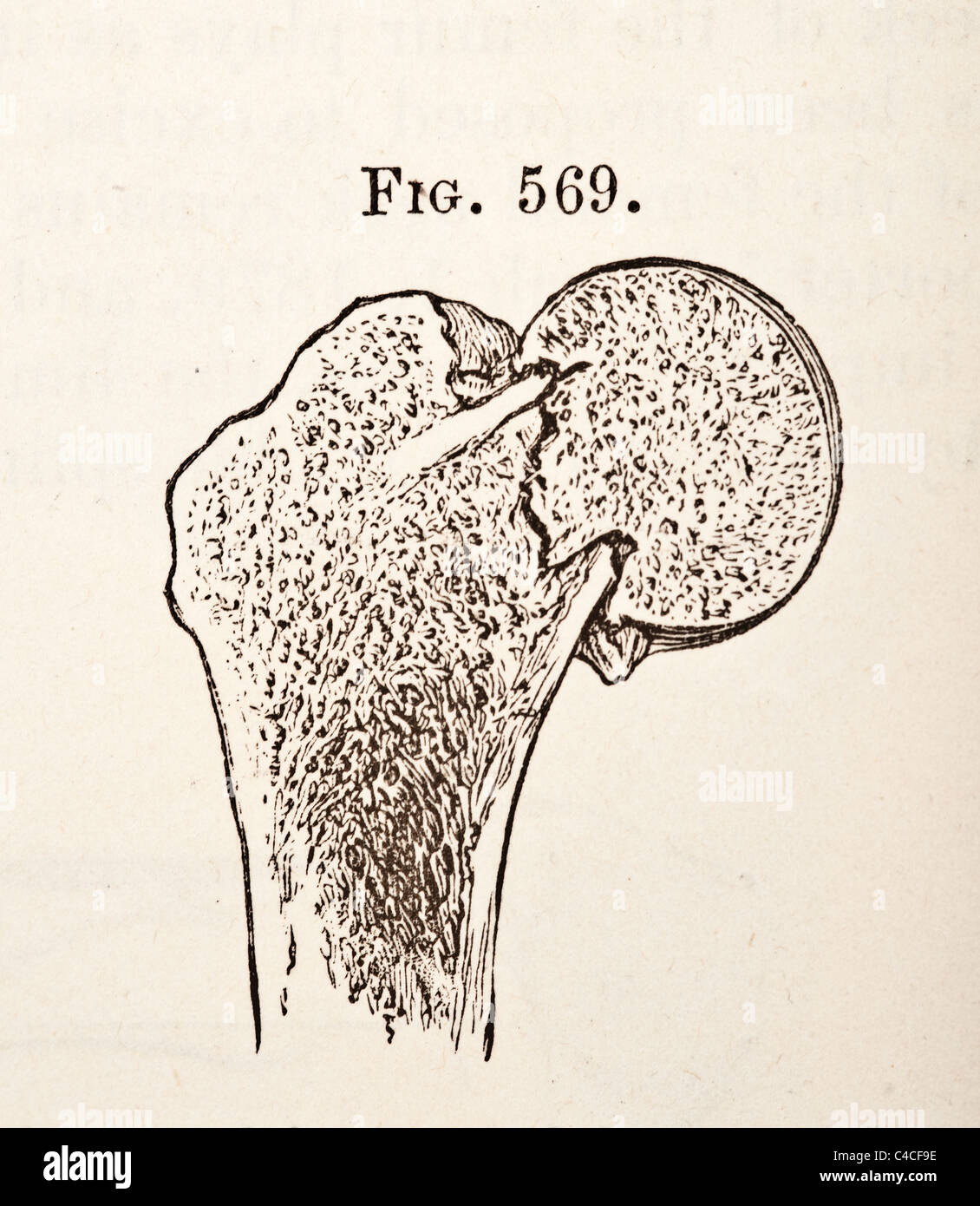 Antique medical illustration of a hip bone, ball & socket Stock Photo ...