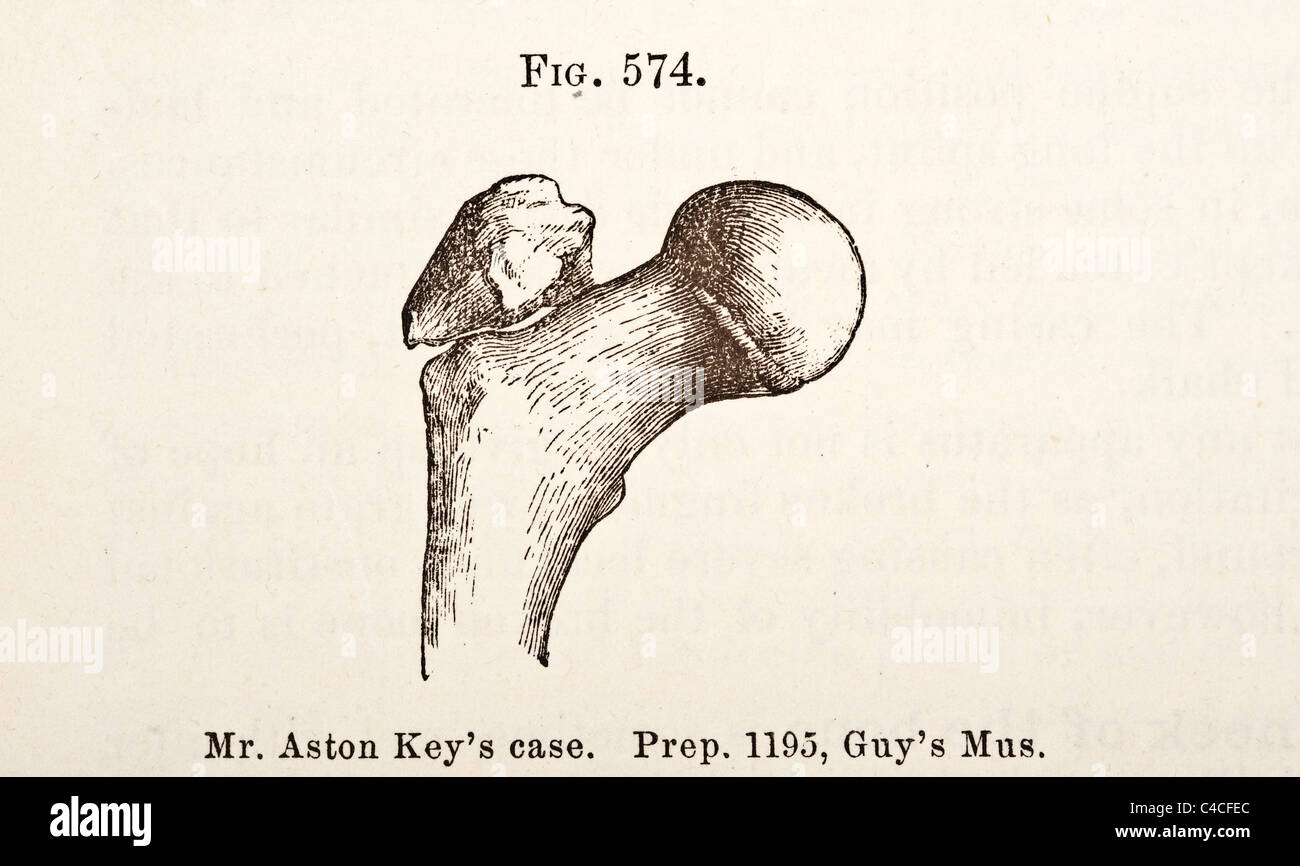 Antique medical illustration of a hip bone, ball & socket Stock Photo ...