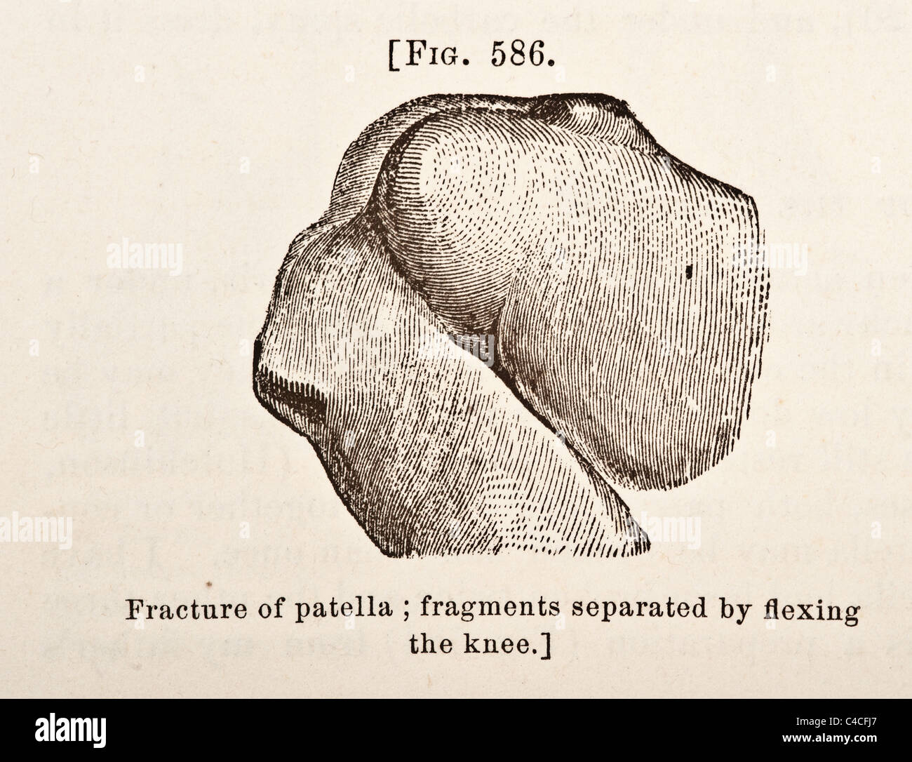 Antique Medical Illustration of Patella circa 1881 Stock Photo - Alamy
