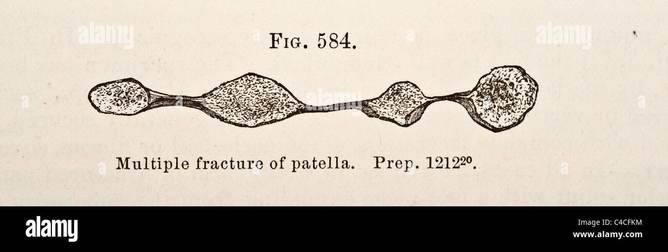 Antique Medical Illustration of Patella circa 1881 Stock Photo - Alamy