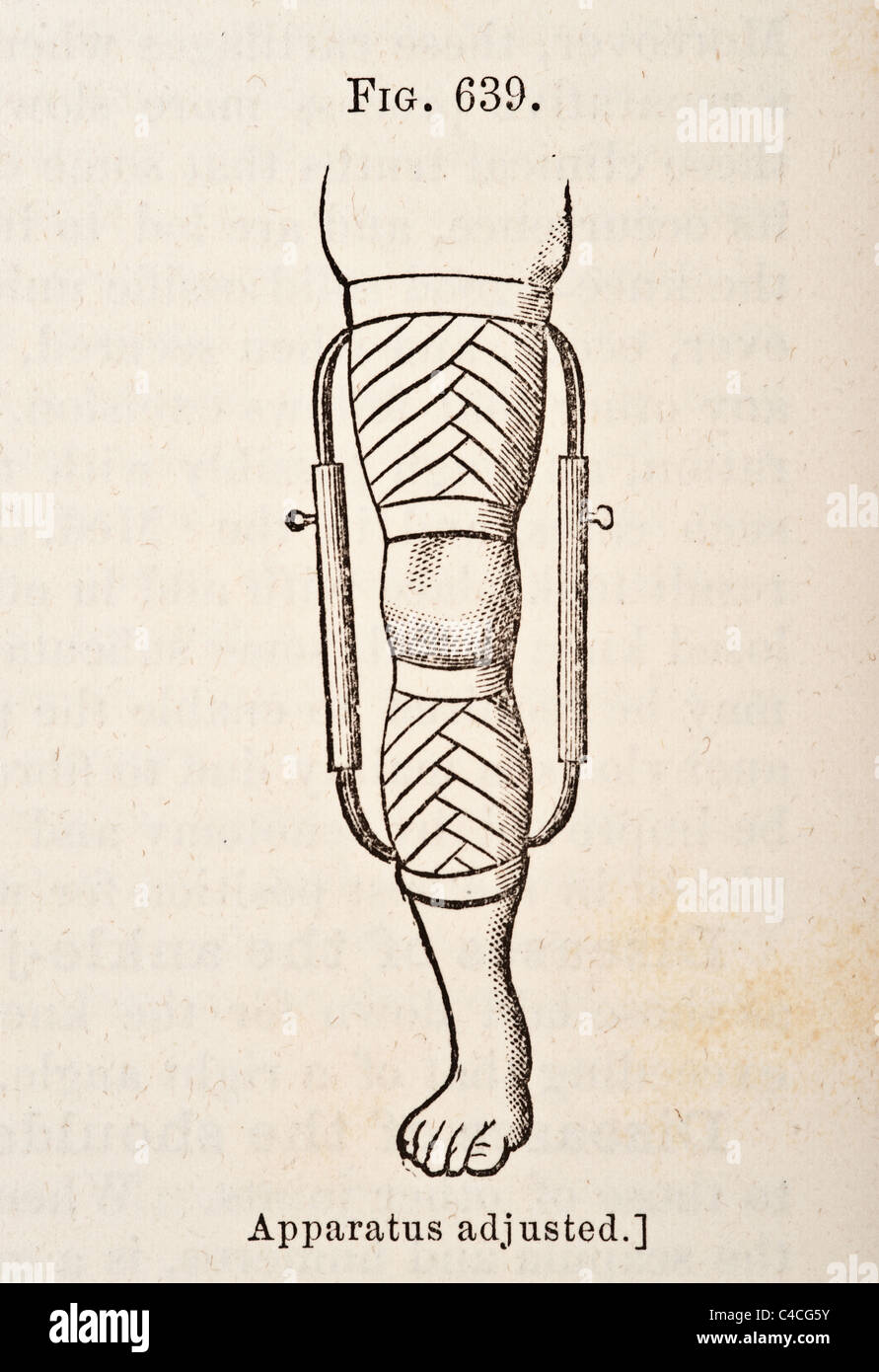 Antique Medical Illustration of Devices Used to Treat Fractures circa ...