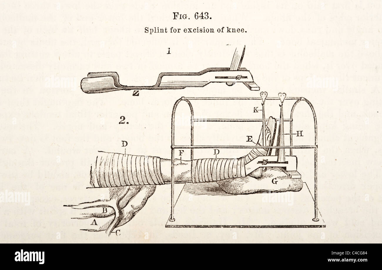 Antique Medical Illustration of Devices Used to Treat Fractures circa ...
