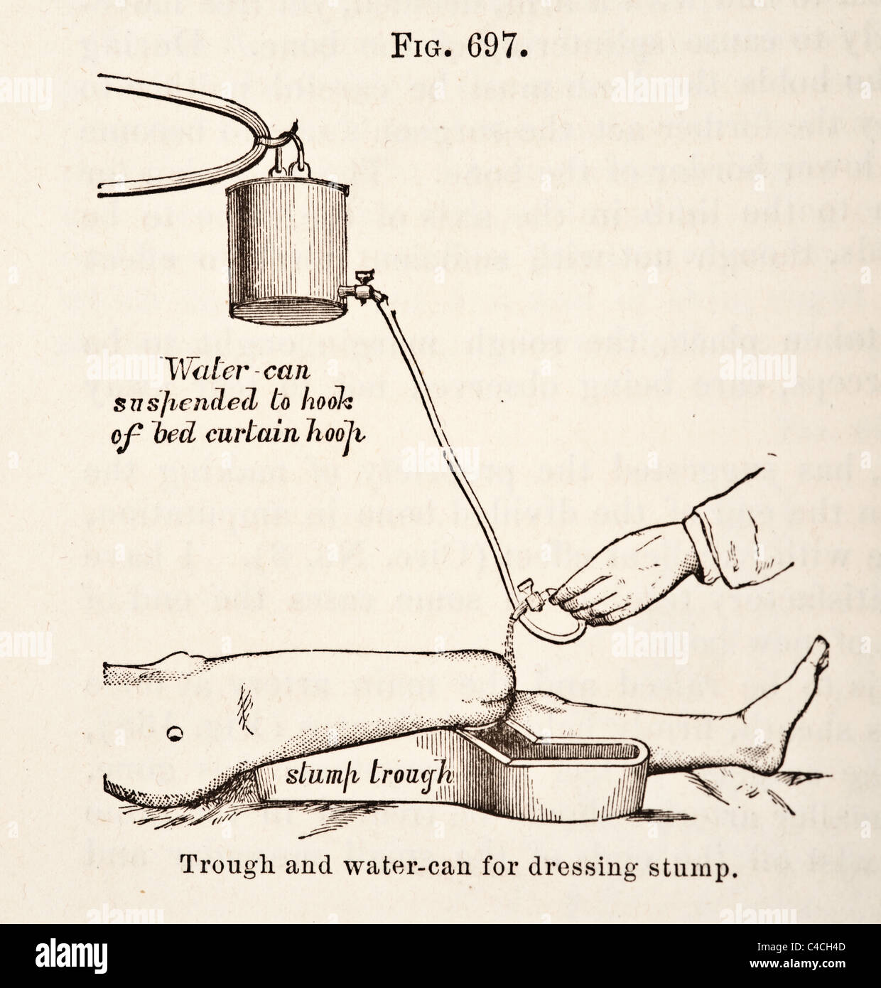Antique Medical Illustration of Amputation(s) Procedure circa 1881 ...