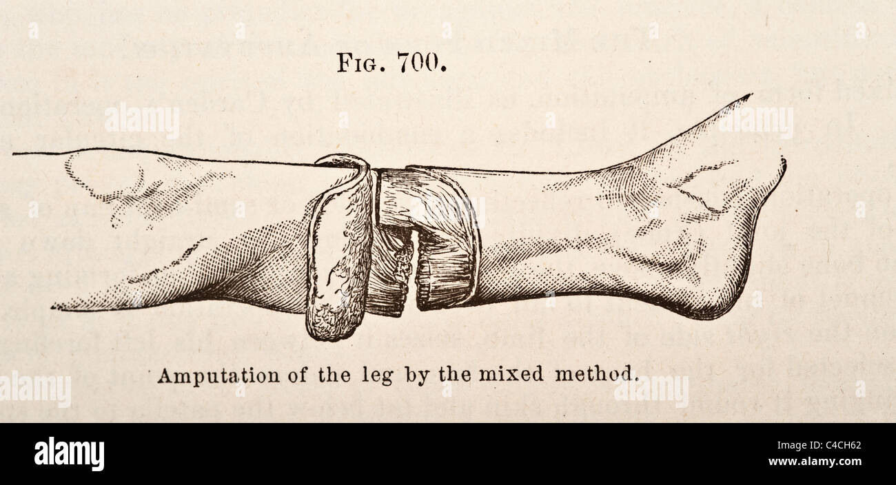 Disarticulation High Resolution Stock Photography and Images - Alamy