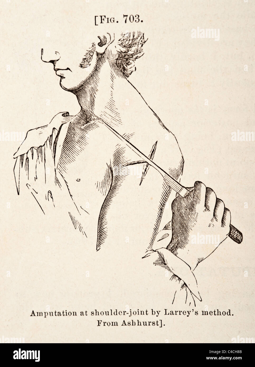 Antique Medical Illustration of Amputation(s) Procedure circa 1881 ...