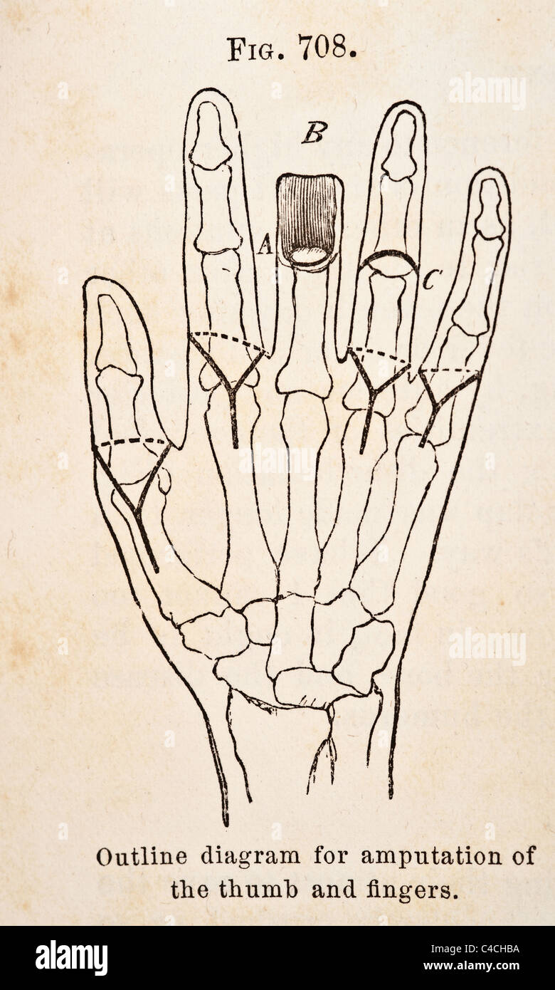 Antique Medical Illustration of Amputation(s) Procedure circa 1881 ...