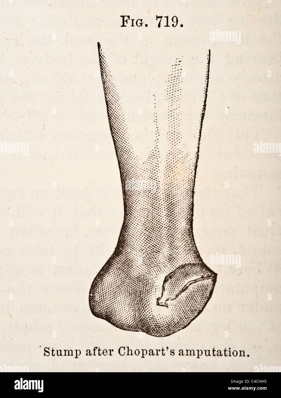 Antique Medical Illustration of Amputation(s) Procedure circa 1881 ...