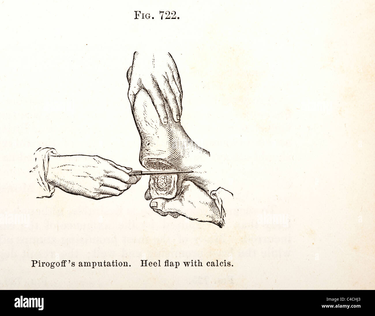 Antique Medical Illustration of Amputation(s) Procedure circa 1881 ...