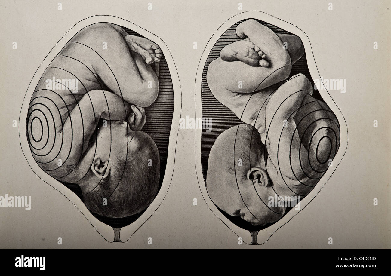 Illustration human birth copyright 1905 hi-res stock photography and ...