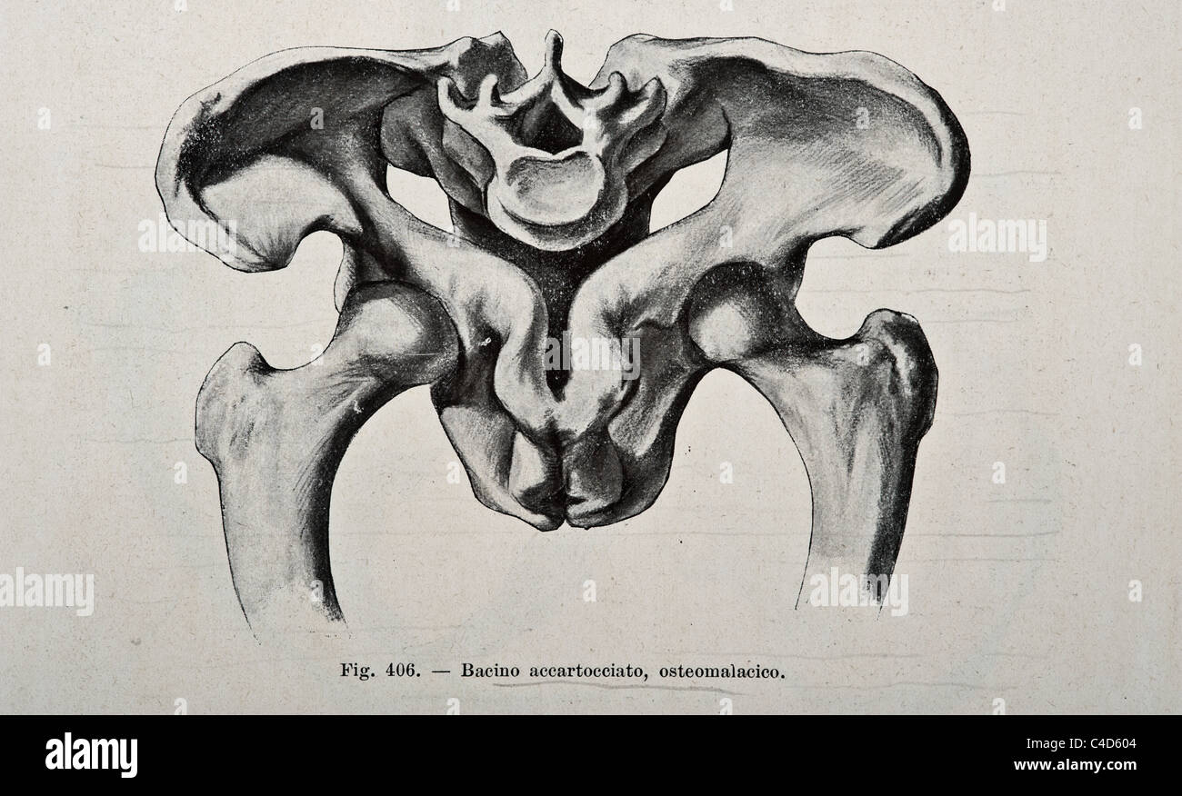 Pelvic brim hi-res stock photography and images - Alamy