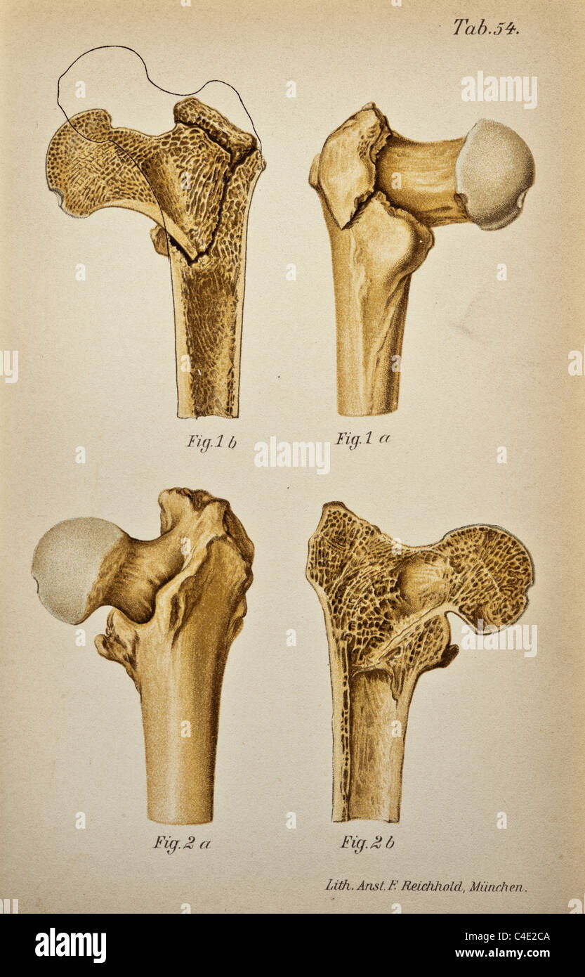 Antique medical illustration of a hip bone, ball & socket Stock Photo ...