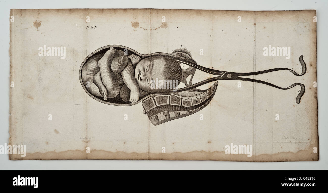 Illustration of a Human Birth copyright 1822 Stock Photo - Alamy