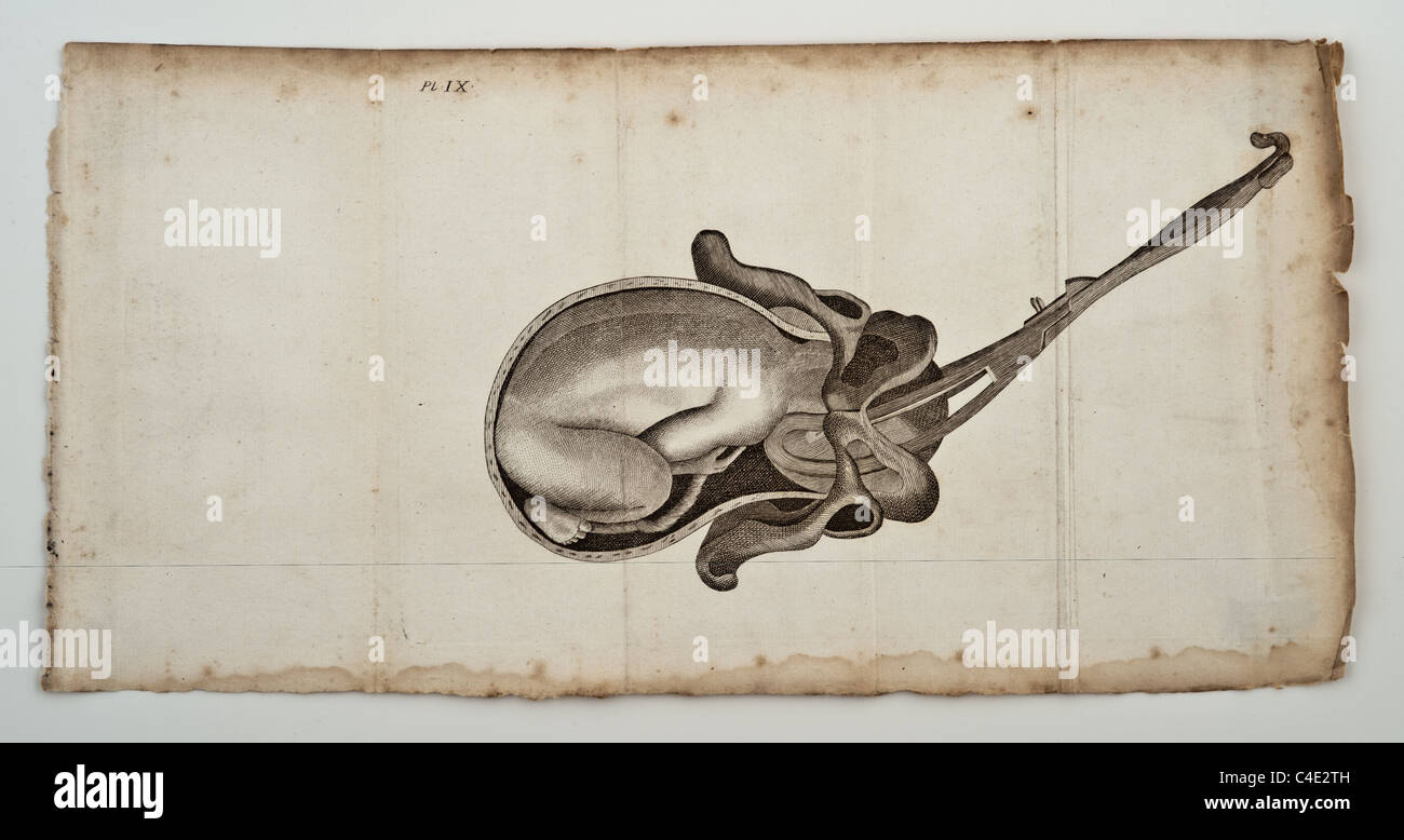 Illustration of a Human Birth copyright 1822 Stock Photo - Alamy