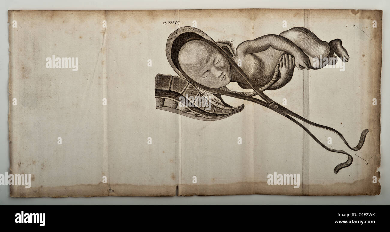 Illustration of a Human Birth copyright 1822 Stock Photo - Alamy
