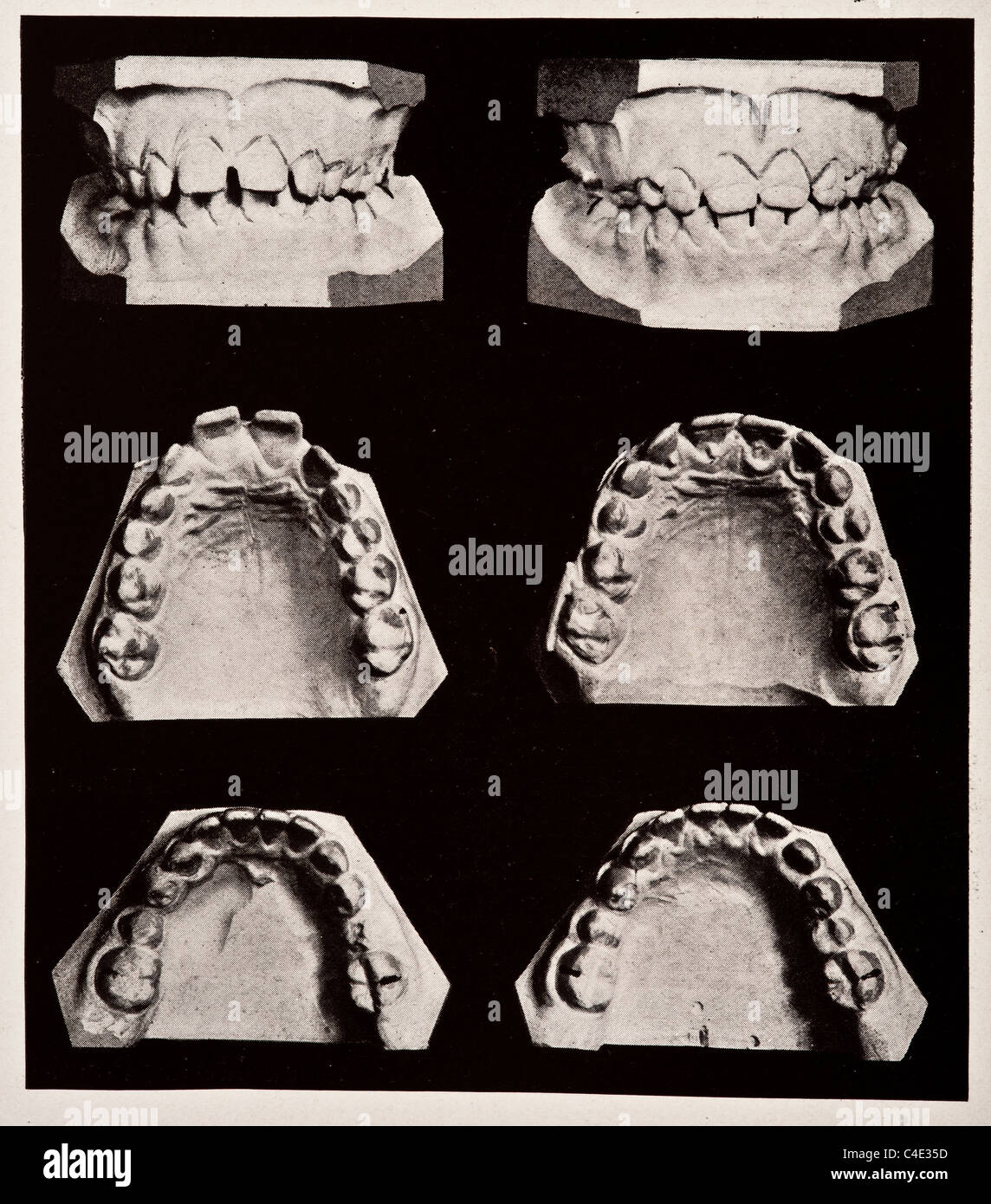 Illustration of Human Teeth Models copyright 1911 Stock Photo - Alamy