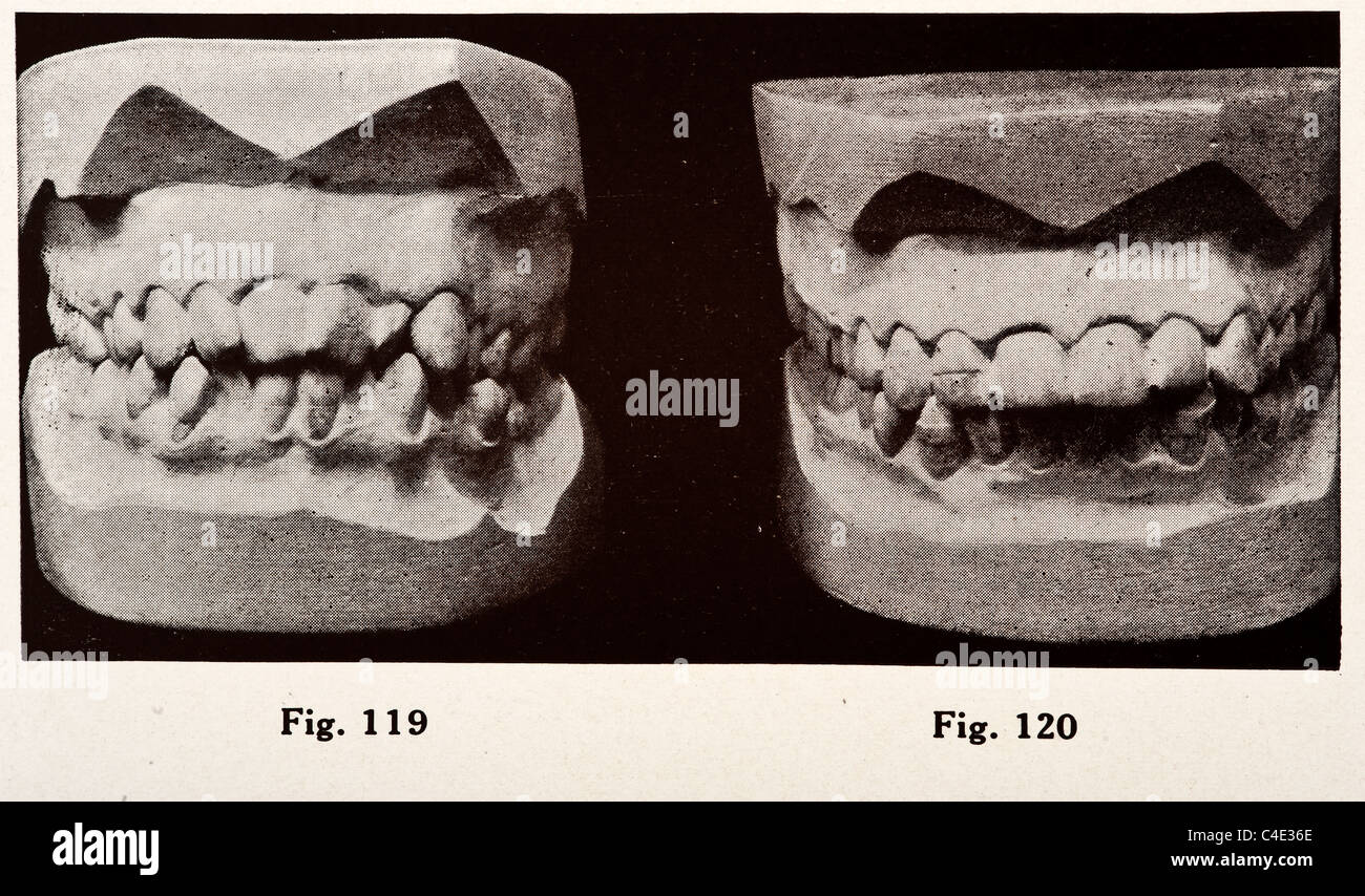 Illustration of Human Teeth Models copyright 1911 Stock Photo - Alamy