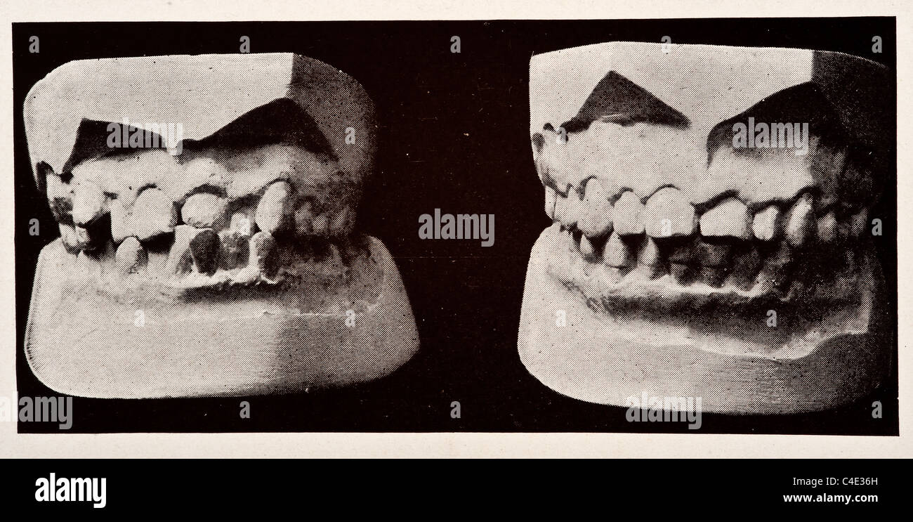 Illustration of Human Teeth Models copyright 1911 Stock Photo - Alamy