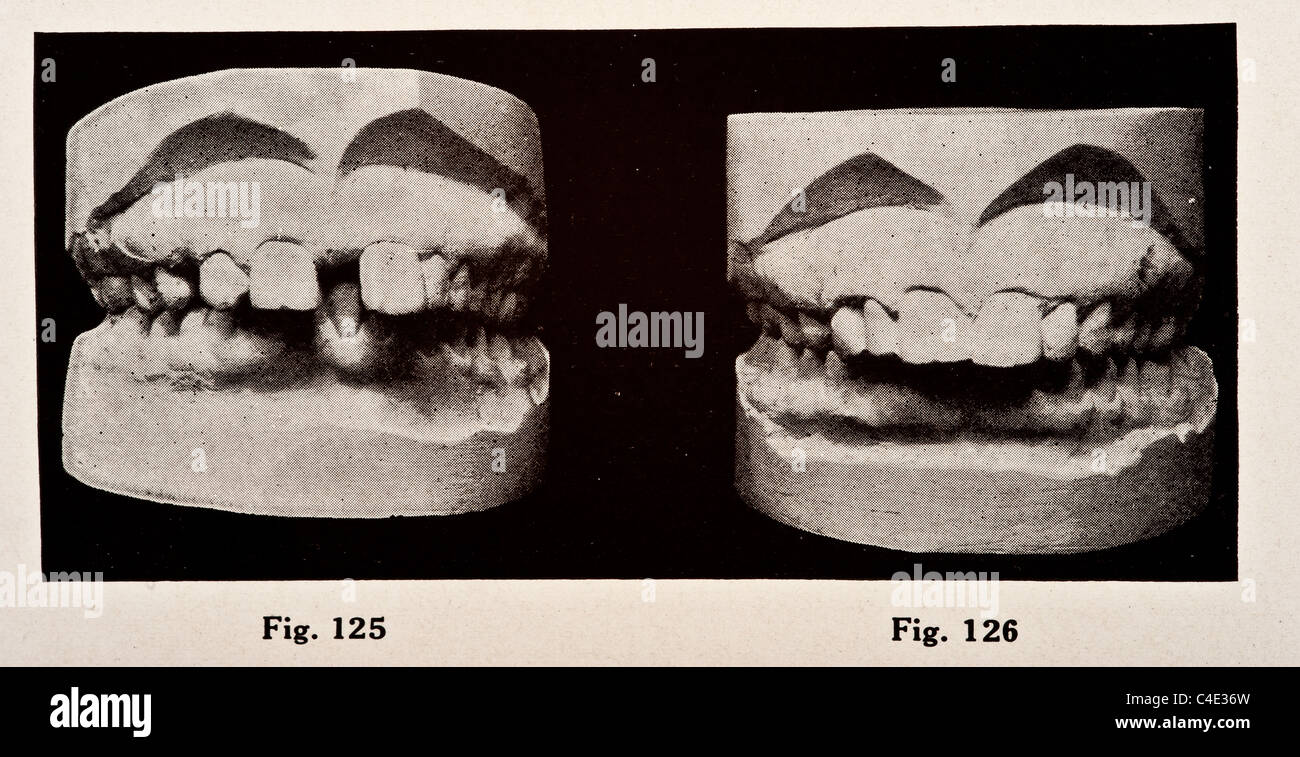 Illustration of Human Teeth Models copyright 1911 Stock Photo - Alamy