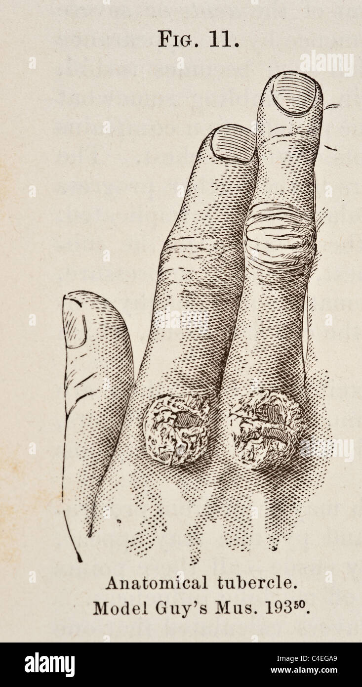 Antique Medical Illustration of Anatomical Tubercle circa 1881 Stock ...