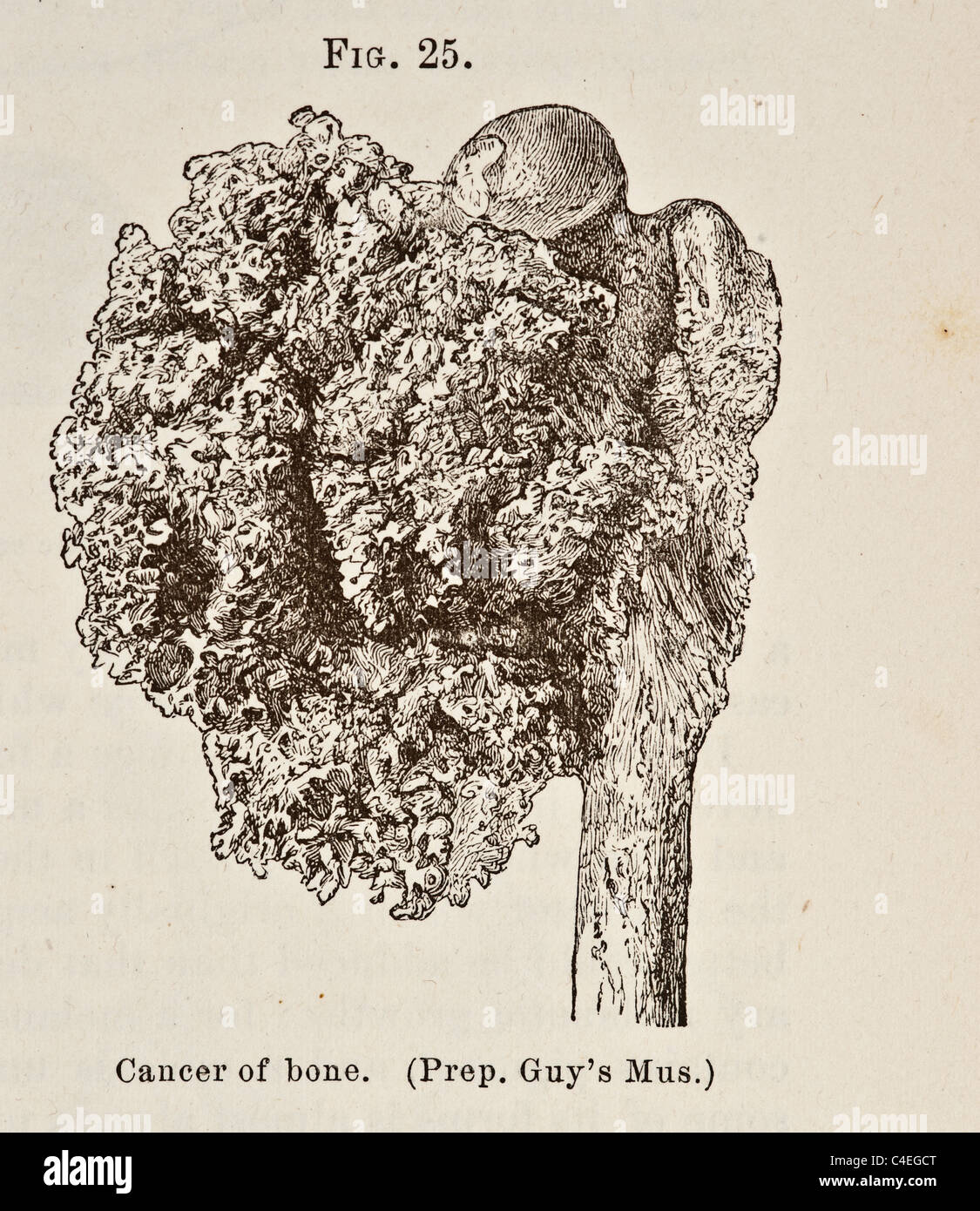 Bone pathology hi-res stock photography and images - Alamy