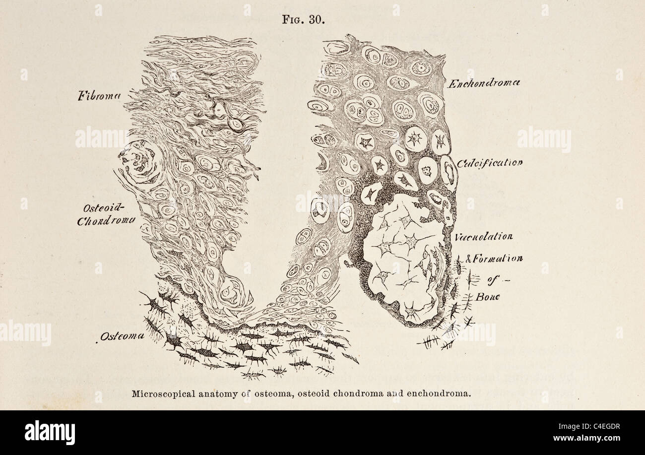 Antique Illustration of Osteoma, Osteoid Chondroma and Enchondroma ...
