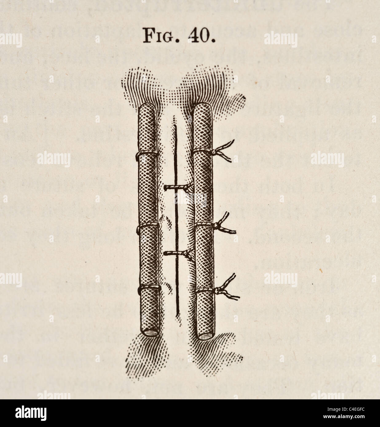 Silk suture hi-res stock photography and images - Alamy