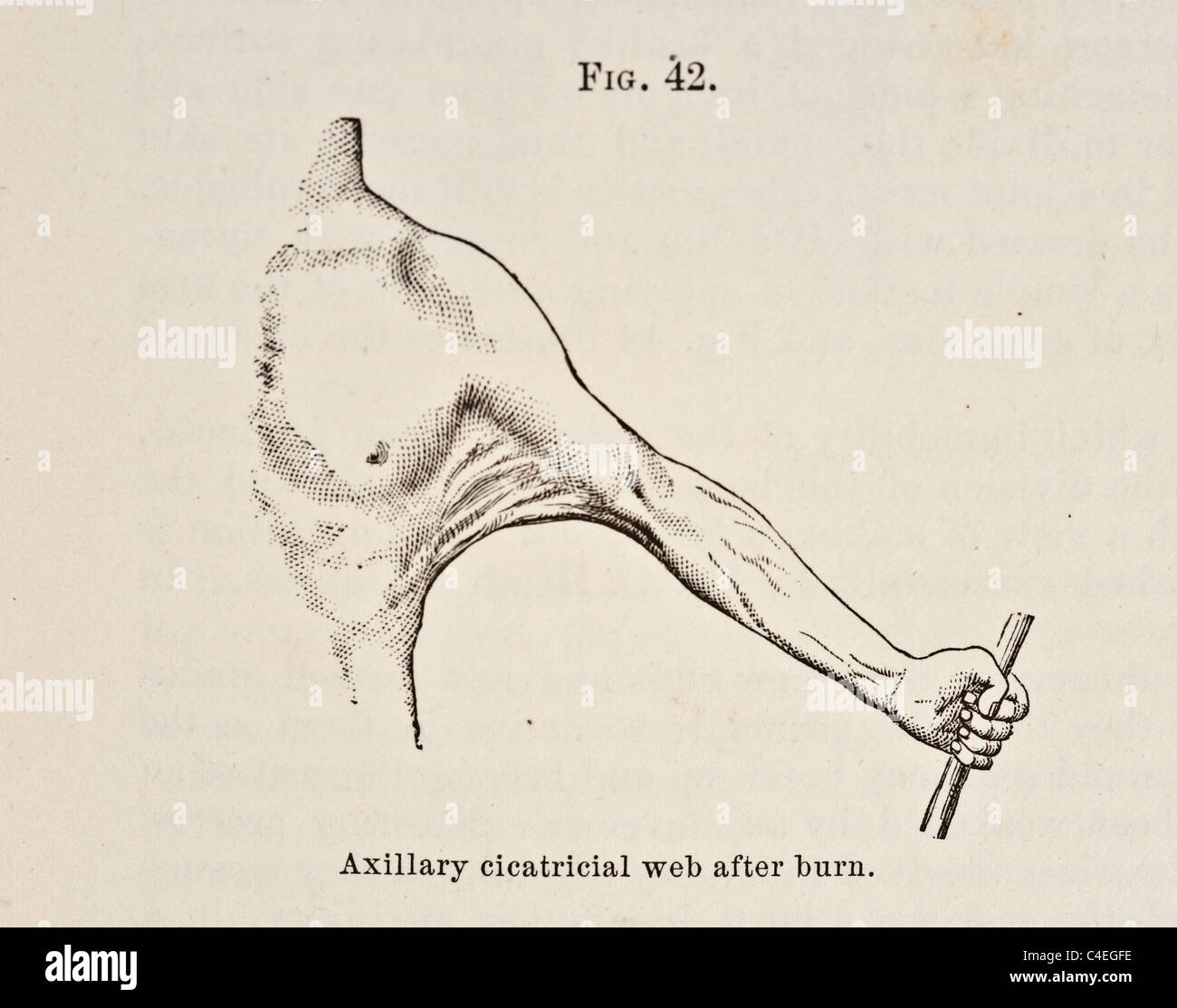 Illustration of Axillary Cicatricial Web After Burn circa 1881 Stock ...