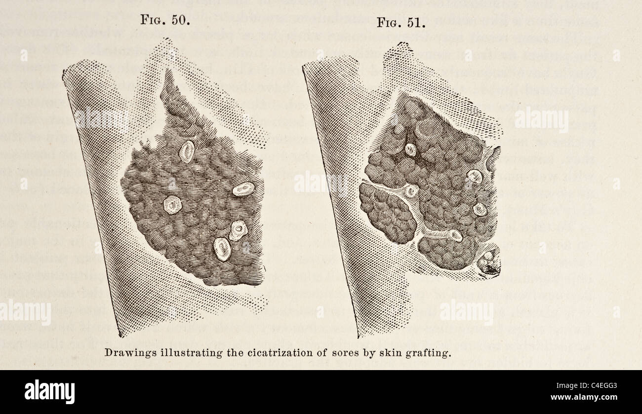 Antique Illustration of Cicatrization of Sores by Skin Grafting circa ...