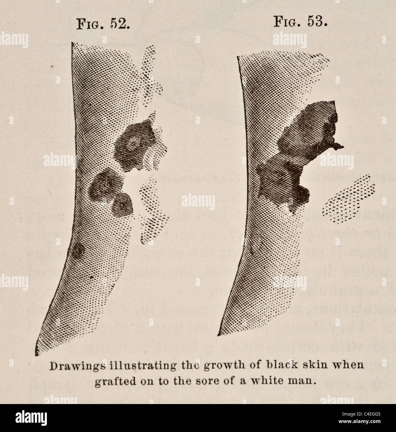 Skin graft hi-res stock photography and images - Alamy