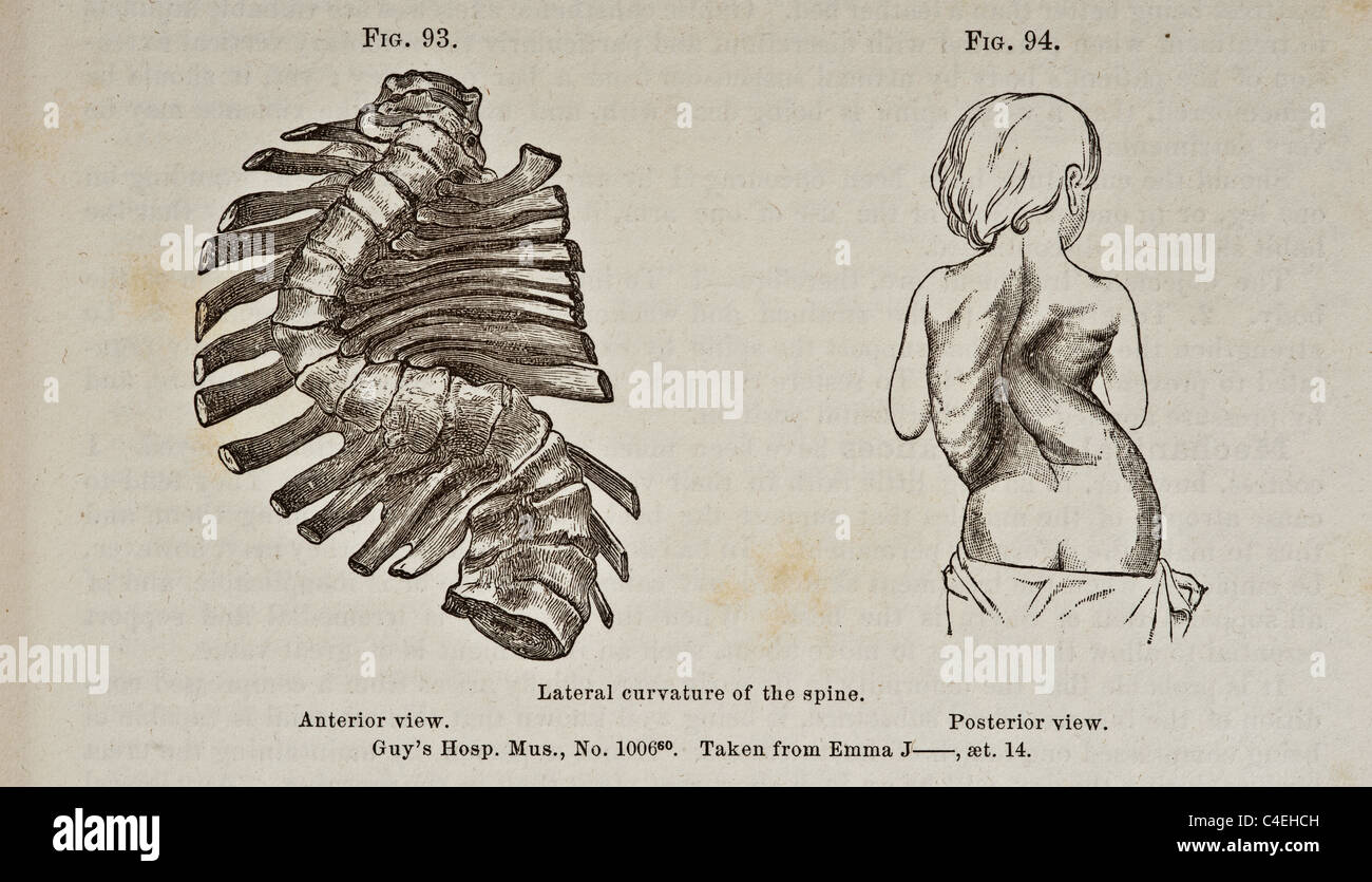 Antique Medical Illustration of a Spine Stock Photo - Alamy
