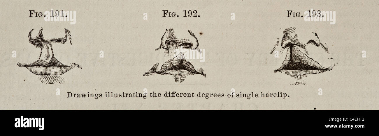 Double harelip hi-res stock photography and images - Alamy