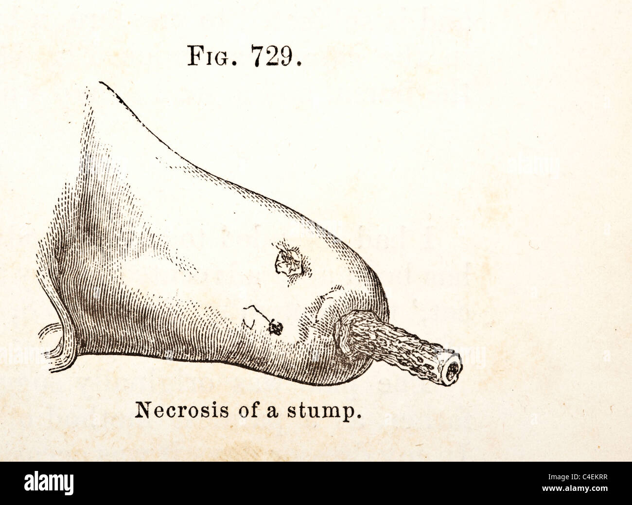Black and white illustration of necrosis of a leg stump, copyright 1881 ...