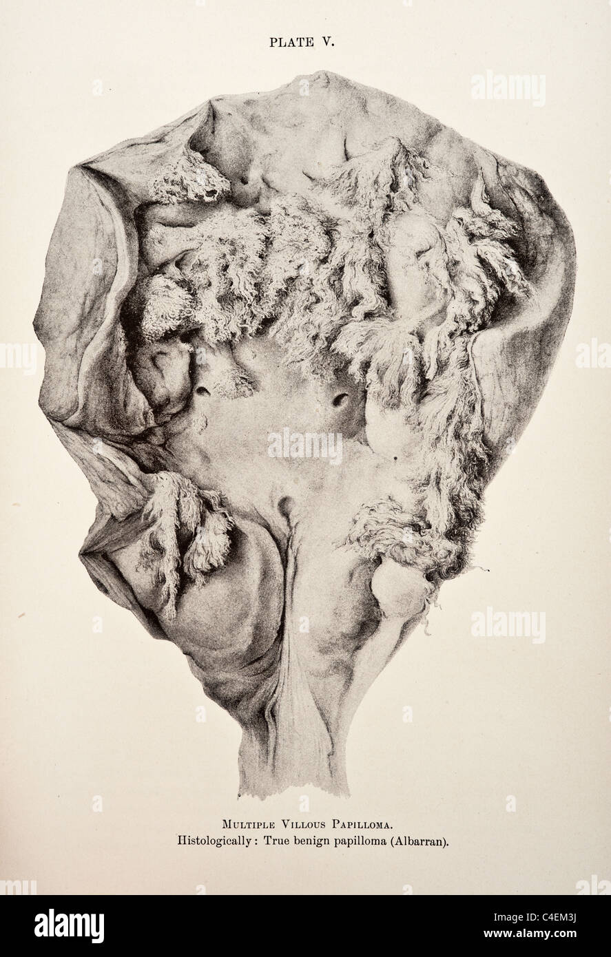 Genito-Urinary Diseases Syphilology and Dermatology copyright 1893 ...