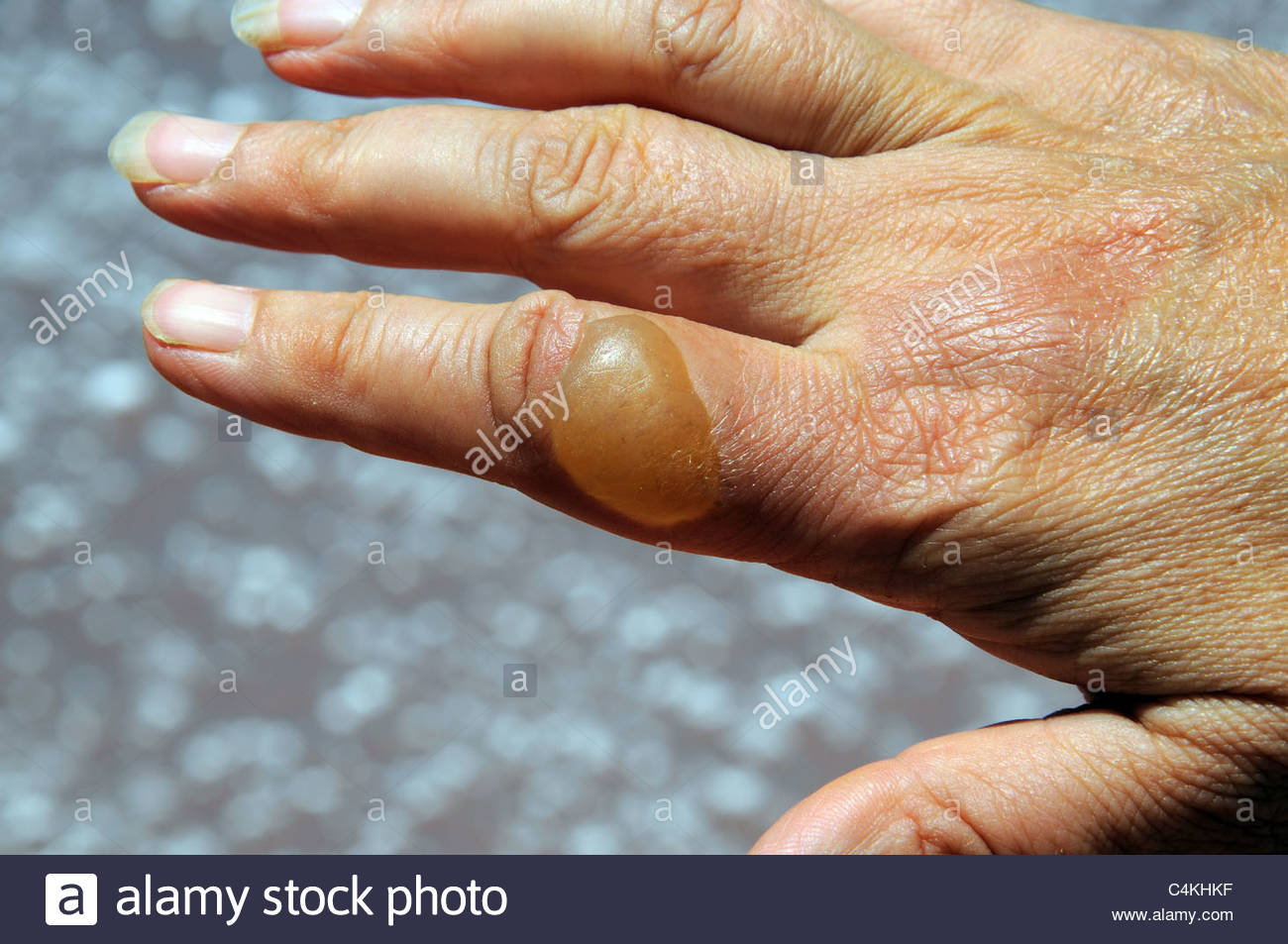 Blister Skin Stock Photos & Blister Skin Stock Images - Alamy