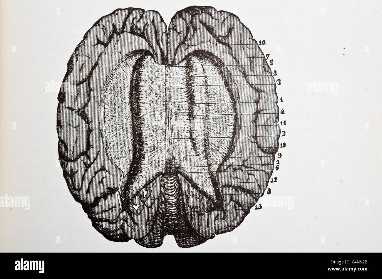 Autopsy brain hi-res stock photography and images - Alamy