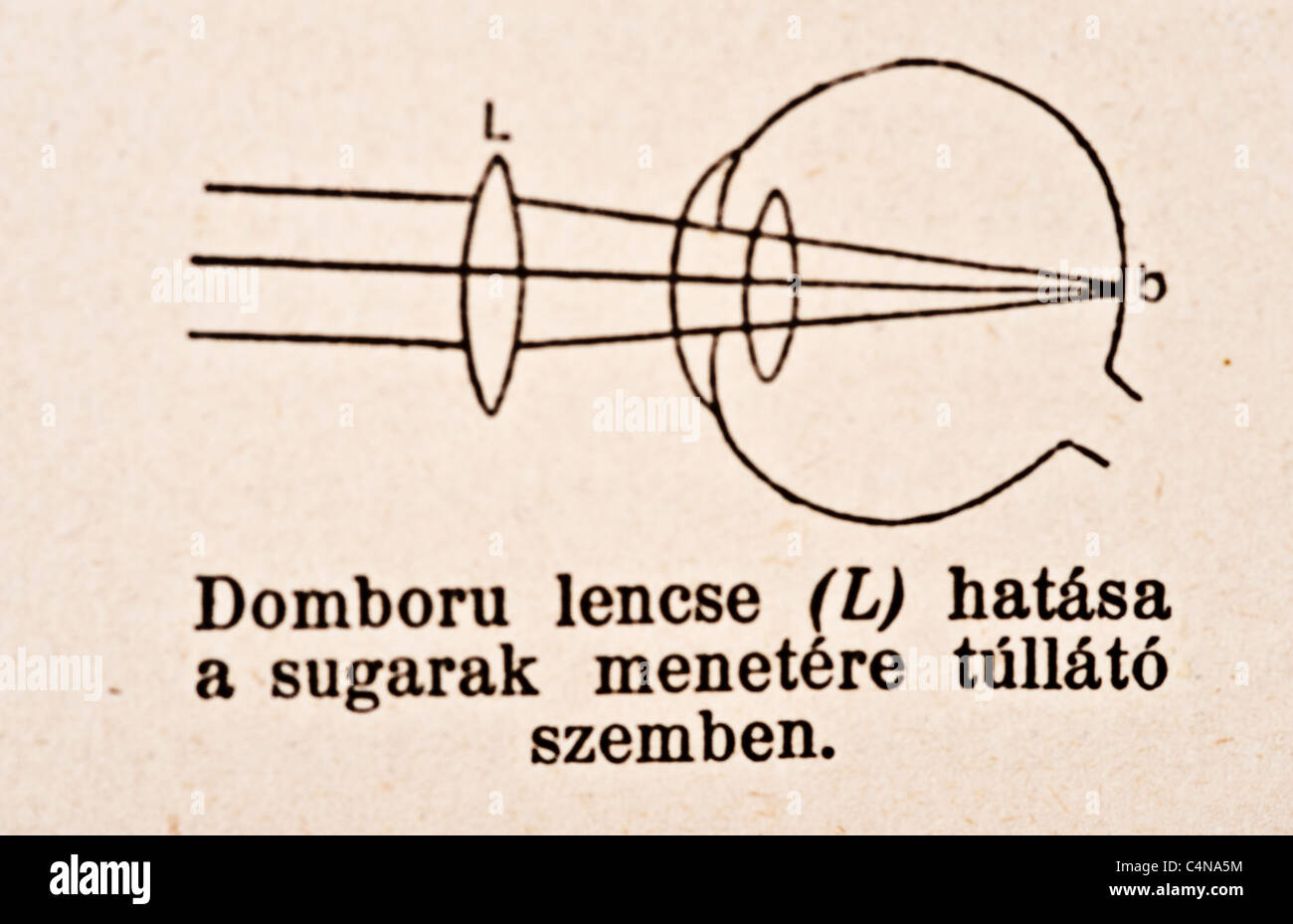 Antique medical illustration of eye disease and Ophthalmologic surgery ...