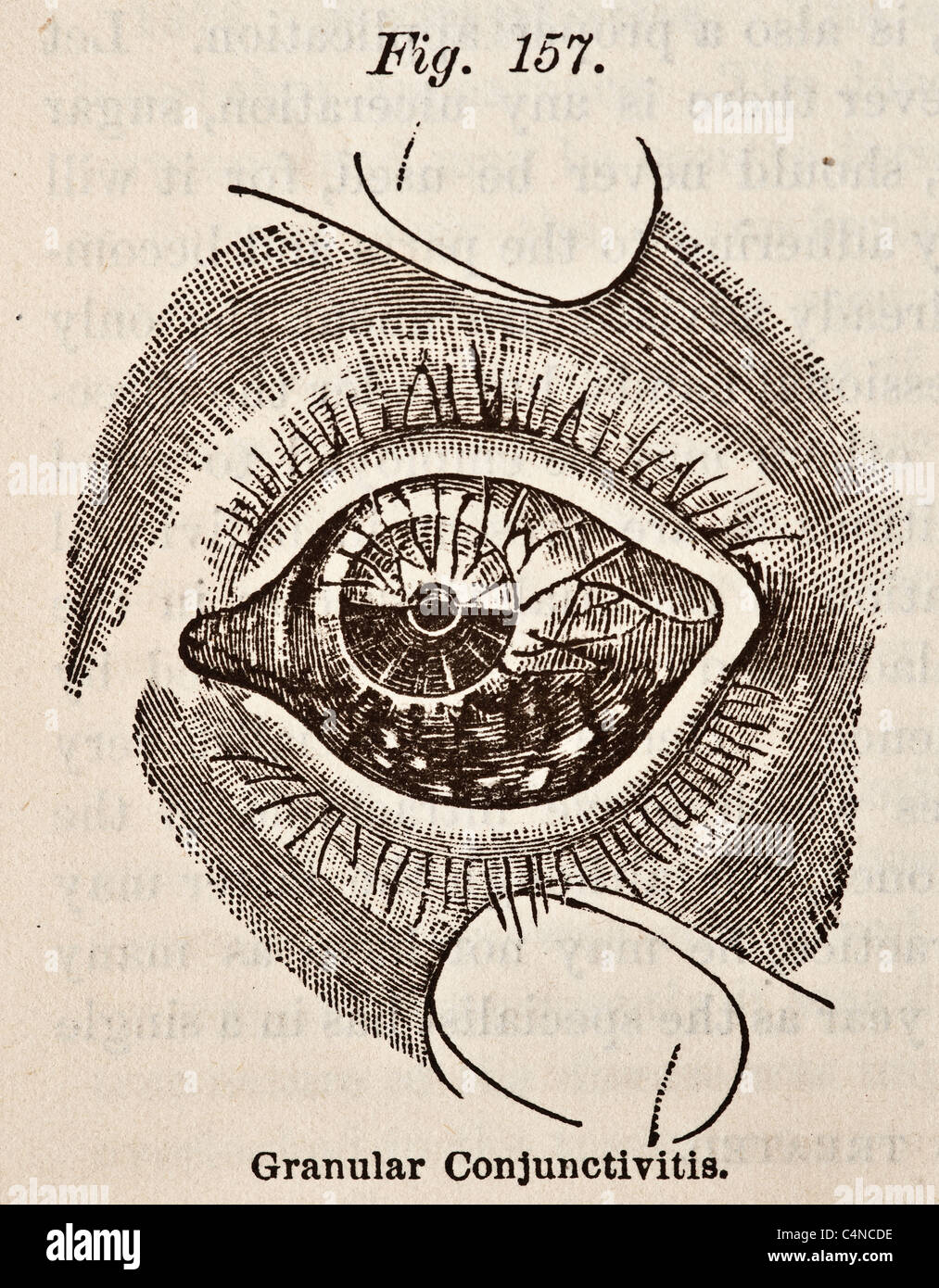 Antique medical illustration of eye disease and Ophthalmologic surgery ...