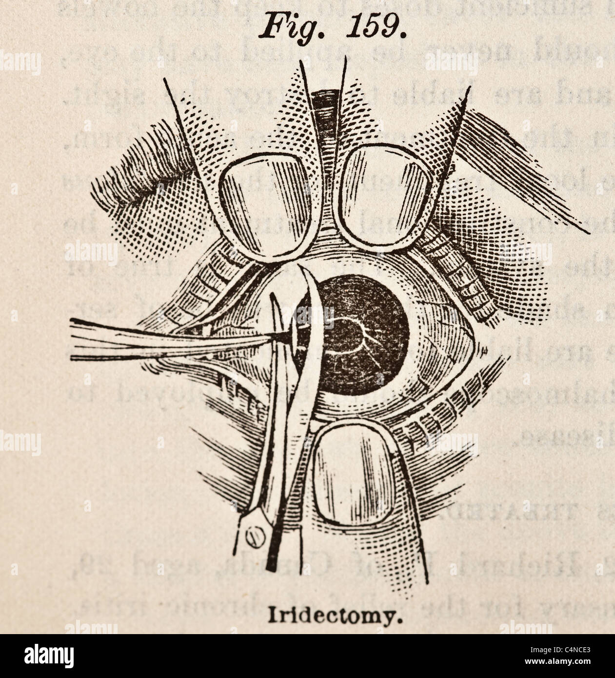 Antique medical illustration of eye disease and Ophthalmologic surgery ... Antique medical illustration of eye disease and Ophthalmologic surgery ...