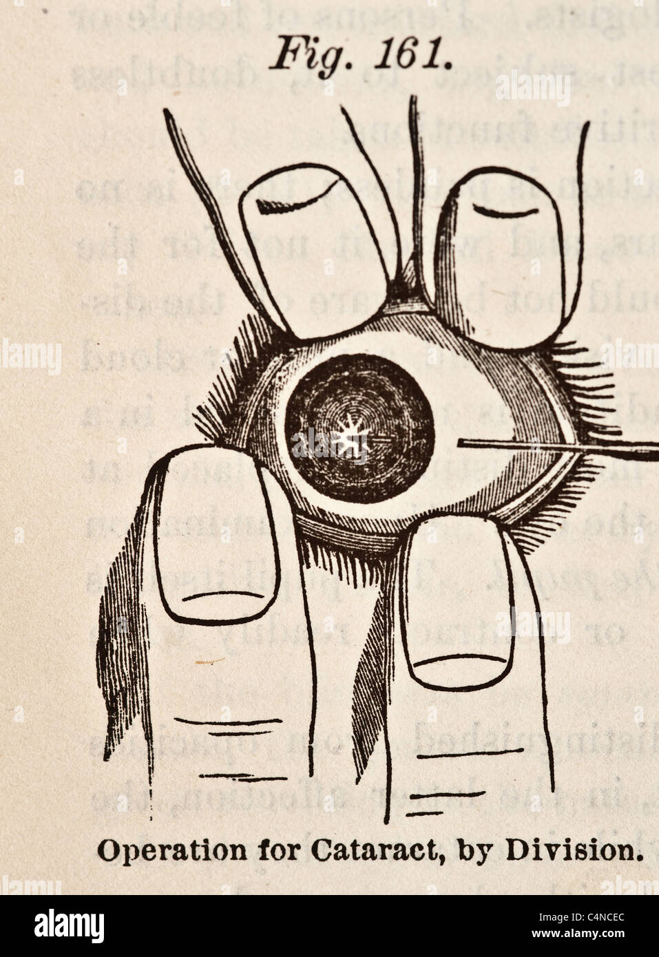 Antique medical illustration of eye disease and Ophthalmologic surgery ...