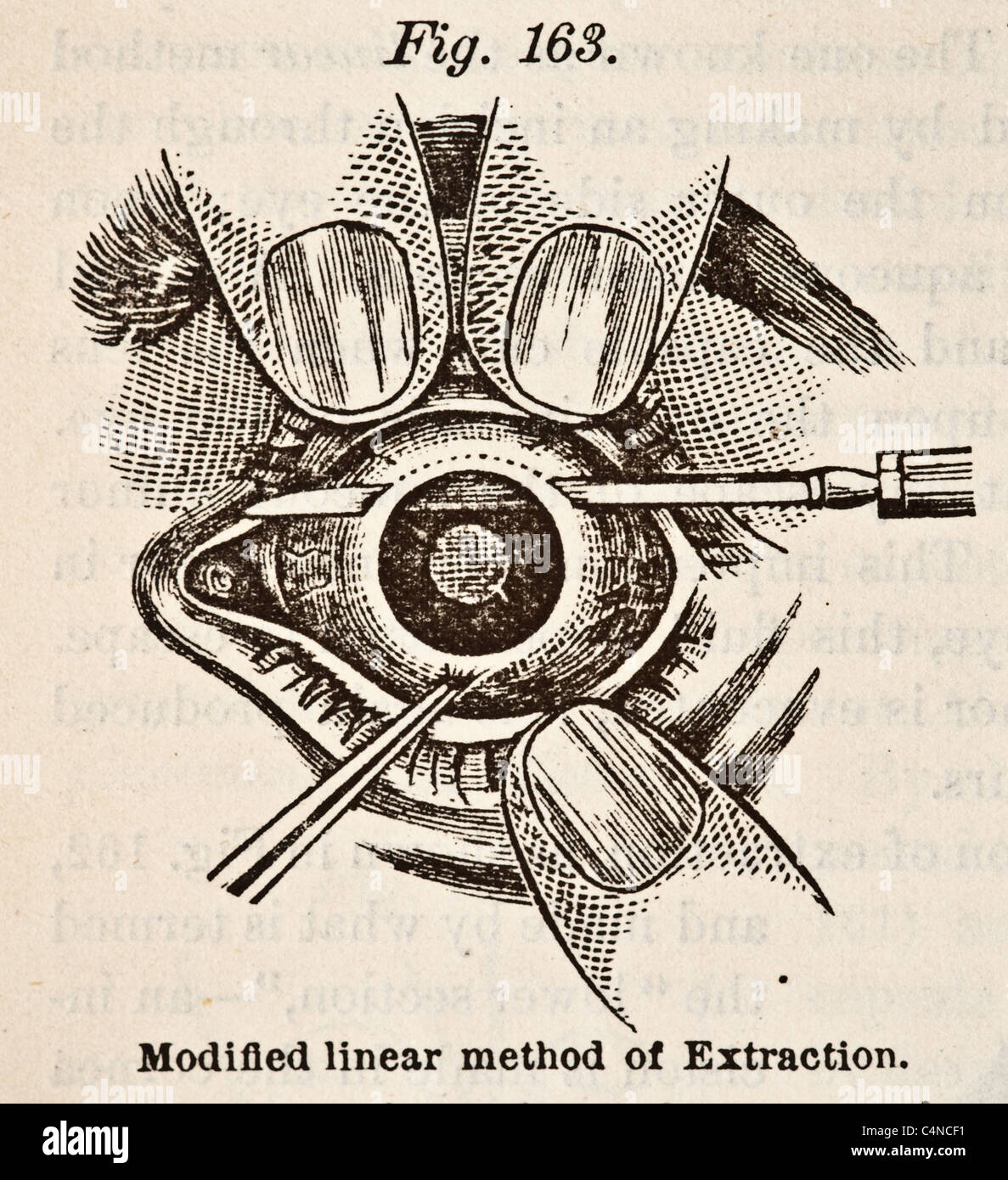 Antique medical illustration of eye disease and Ophthalmologic surgery ...