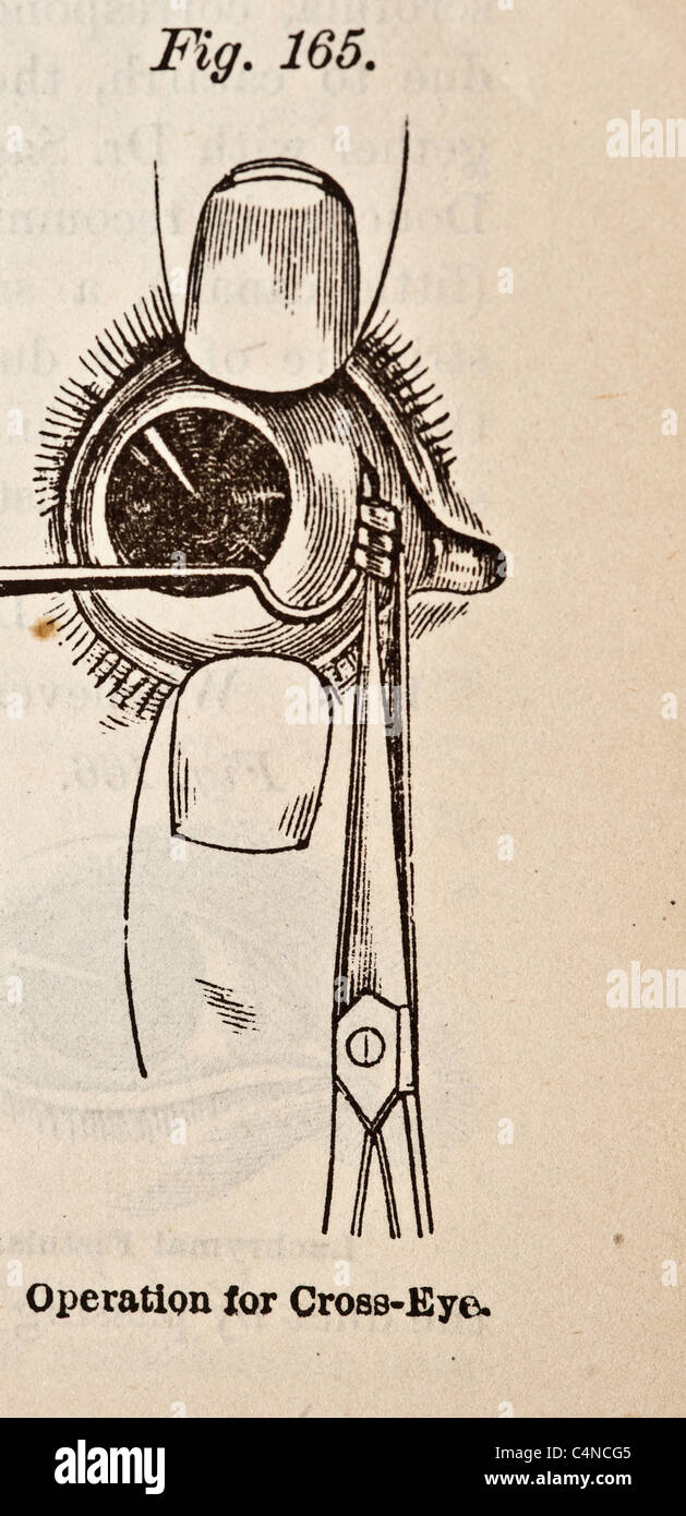 Antique medical illustration of eye disease and Ophthalmologic surgery ...