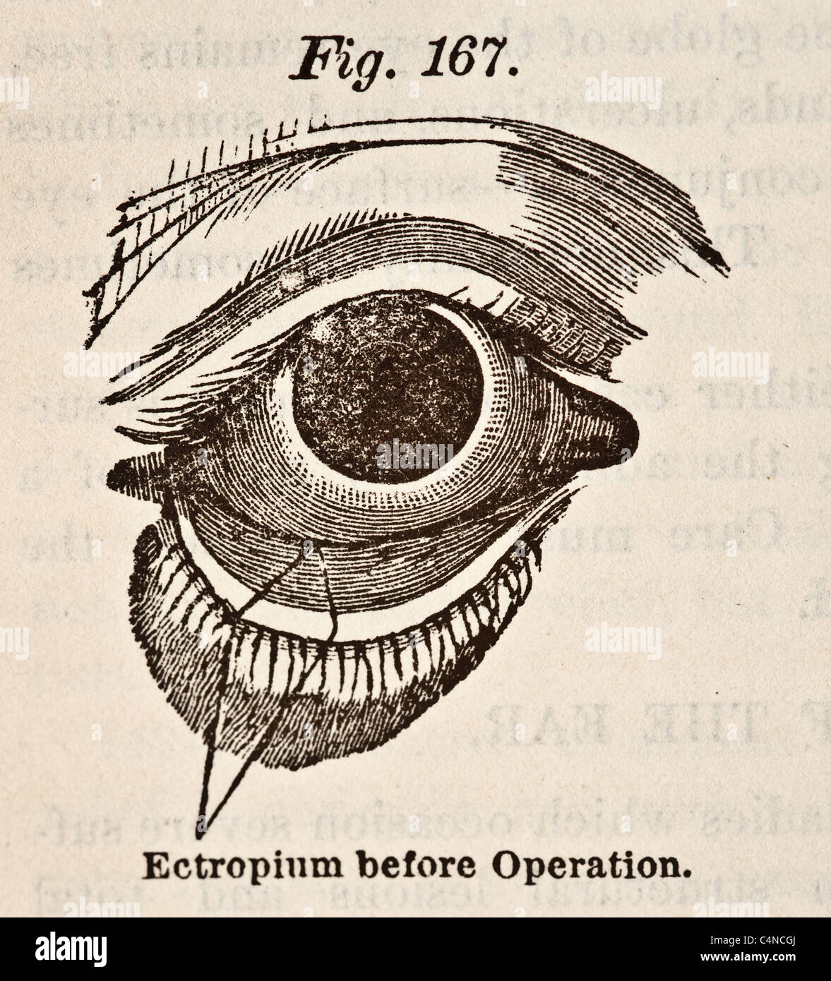 Antique medical illustration of eye disease and Ophthalmologic surgery ...